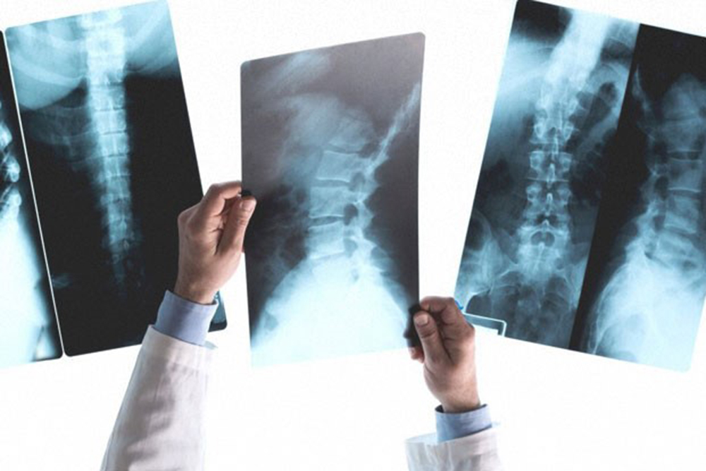 Fibrodisplasia Ossificante Progressiva Saiba Mais Sobre A
