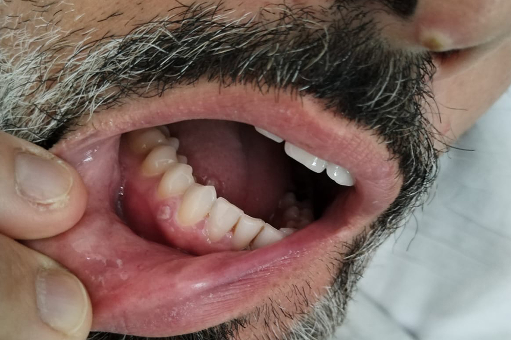 Rara necrose no nariz e 'afta' podem ser causadas pela varíola dos ...